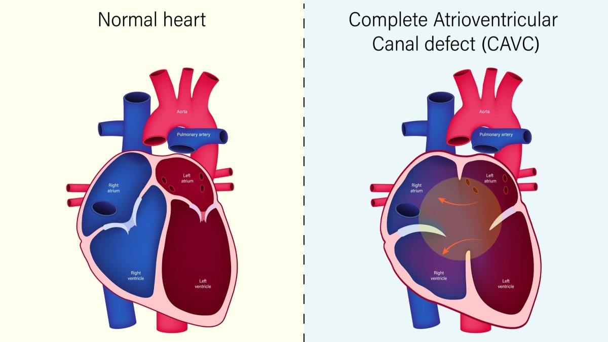 Gene behind heart defects in Down syndrome finally identified | News ...