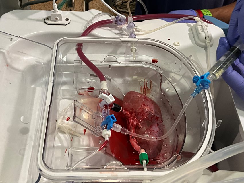 Pig kidneys enable scalable production of human kidney organoids | News ...