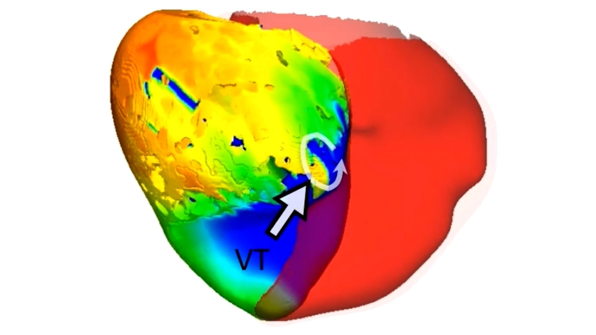 Digital twin technology improves heart procedure outcomes | News ...